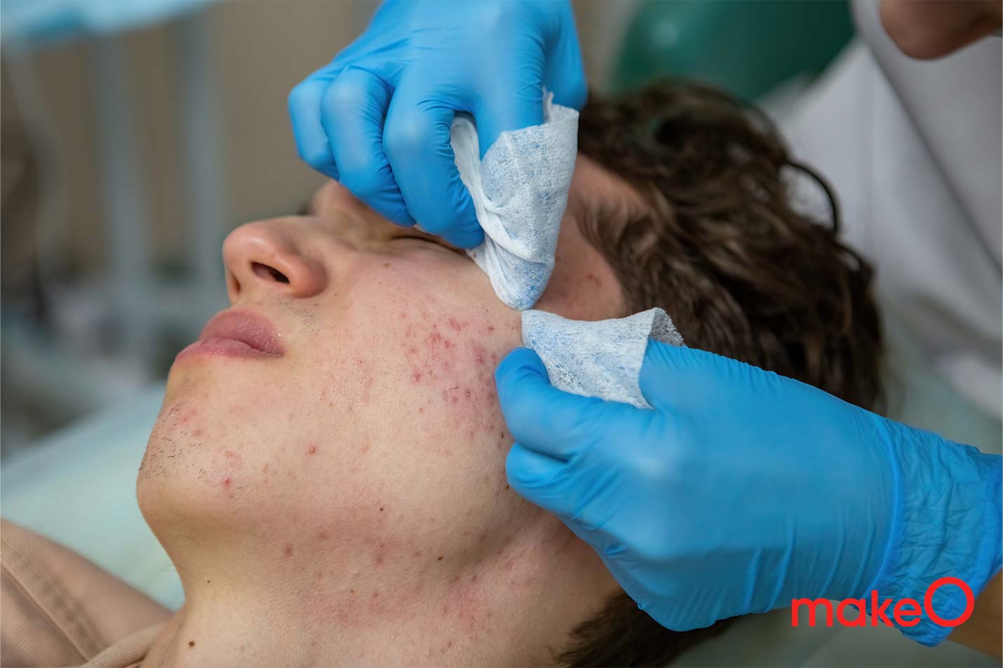 9 Things You Must Know Before You Use Any Acne Spot Treatment