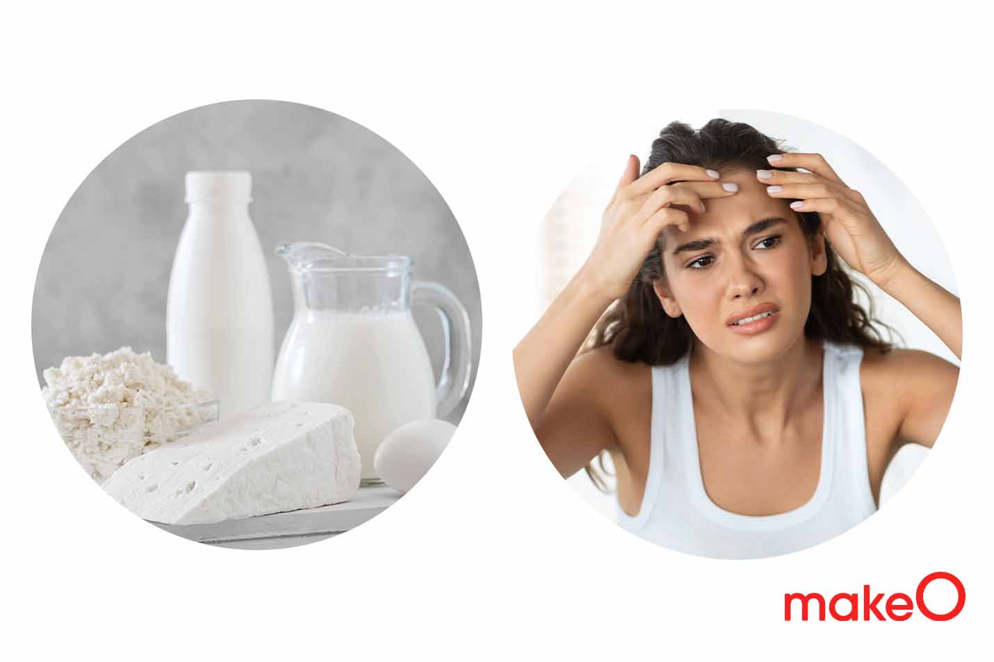 Do Dairy Products Cause Acne Makeo Skinnsi