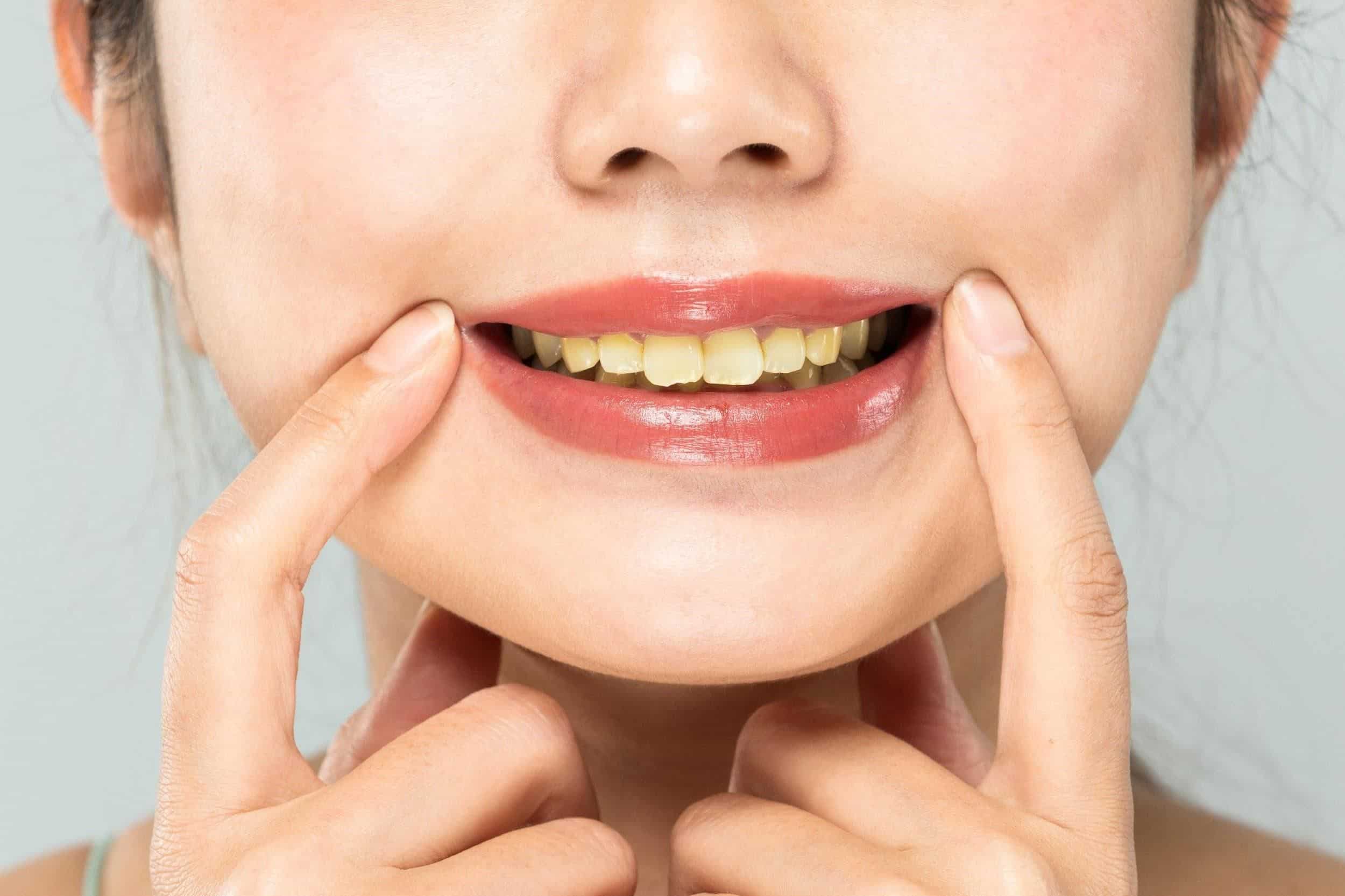 Yellow teeth: Causes & Treatment | makeO toothsi