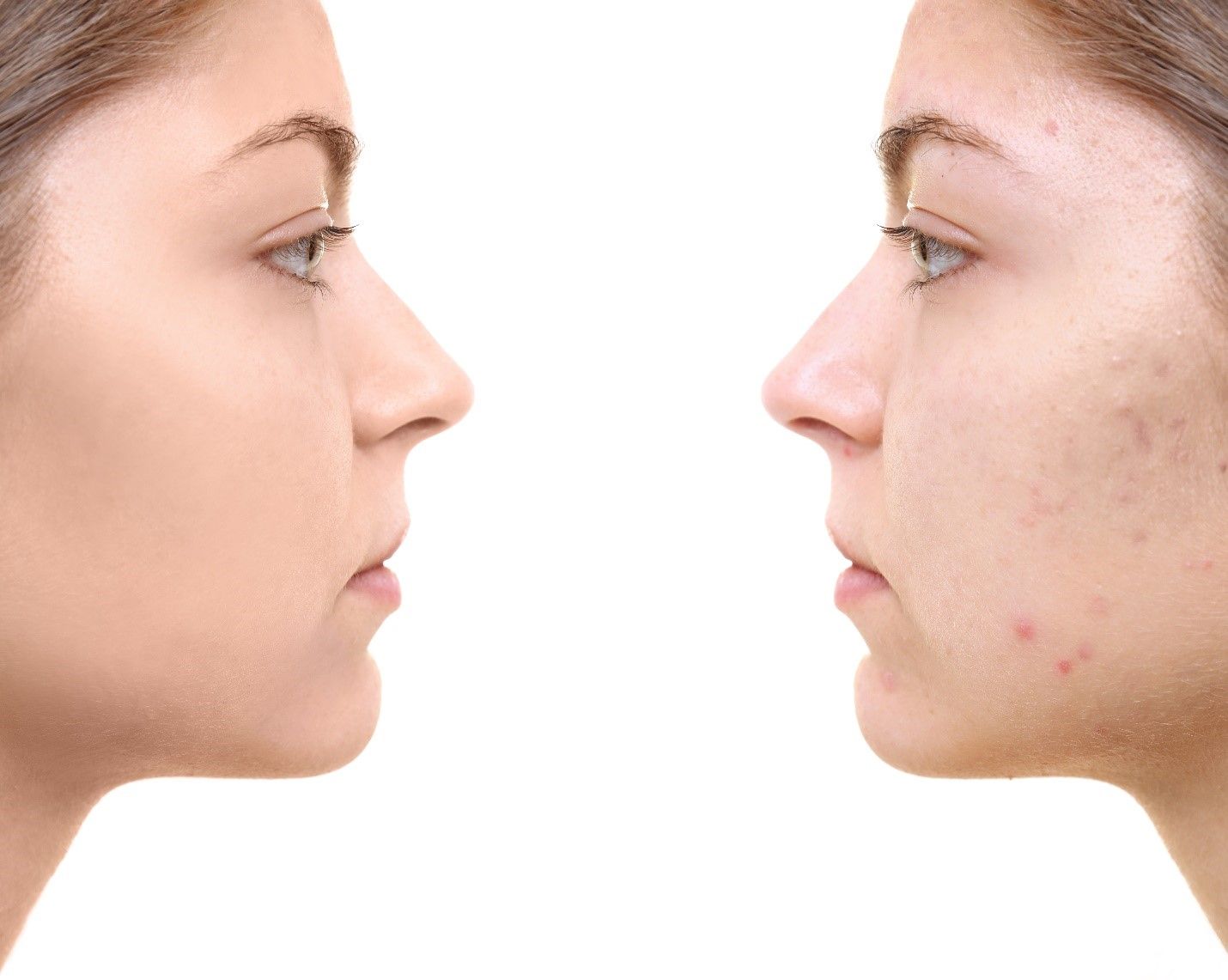 An Insight Into What Causes Acne | makeO skinnsi