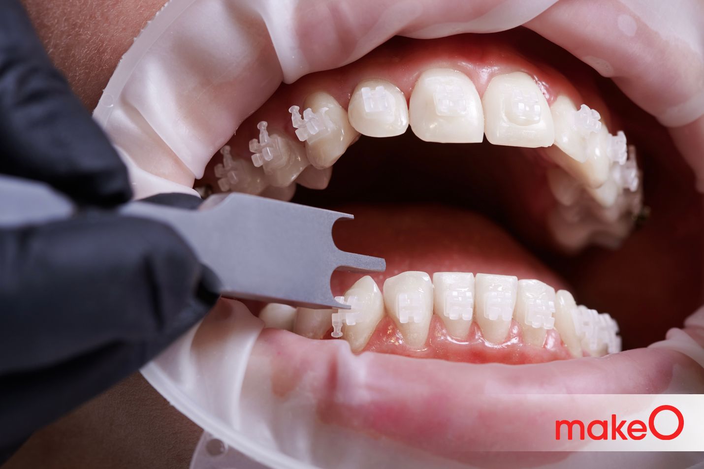 Using Cheek Retractors? Avoid These 4 Mistakes