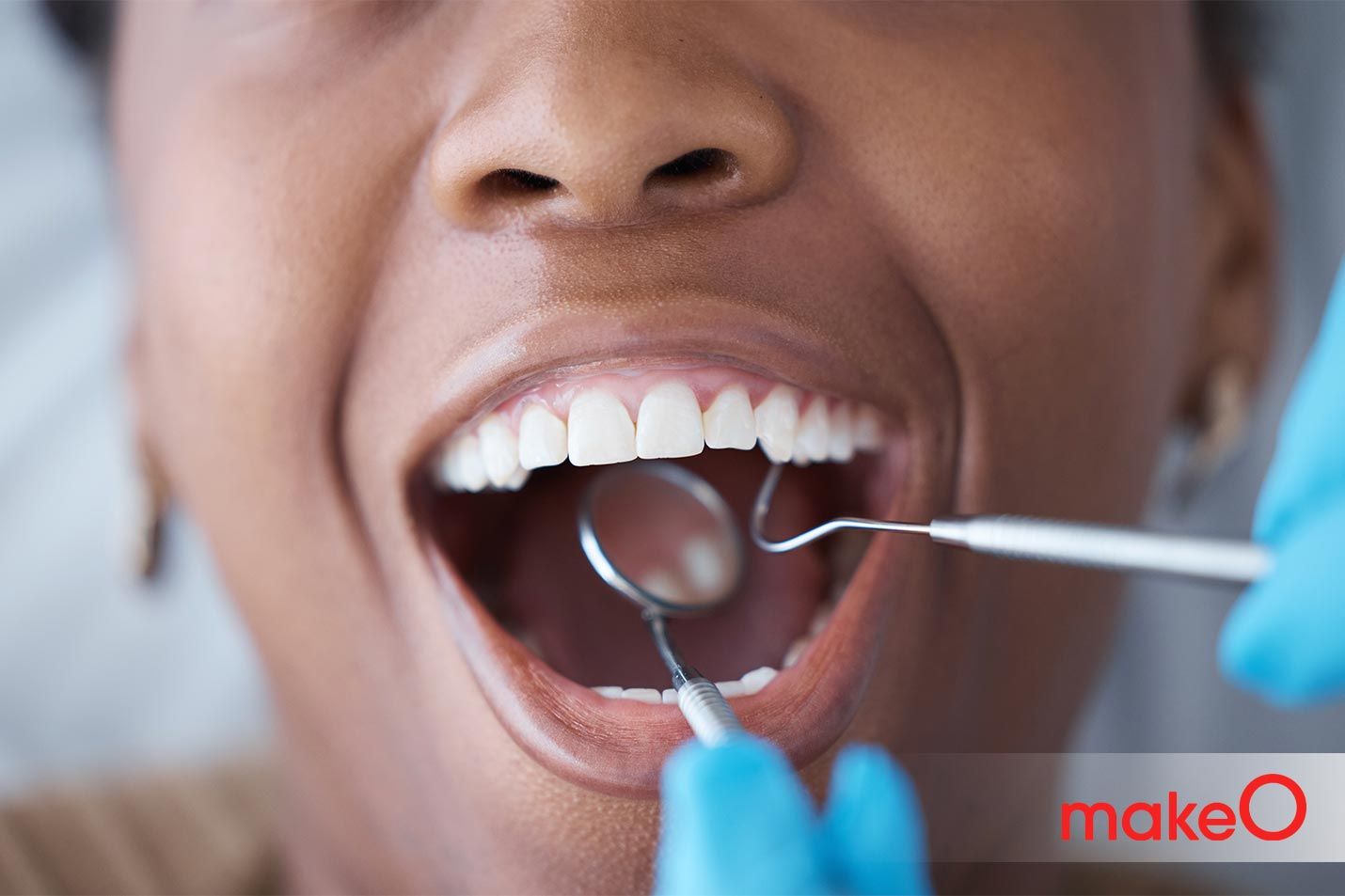 Dens Invaginatus or Dens in Dente: What is this Oral Condition?