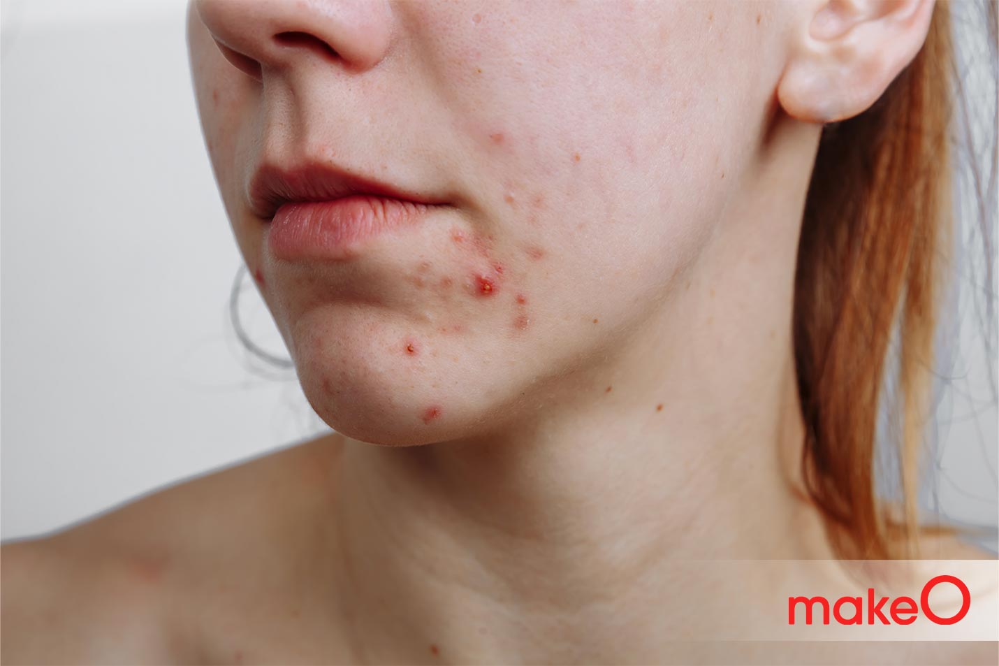 Papule Acne Vs Pustule Acne: Know About Red Bumps On Skin