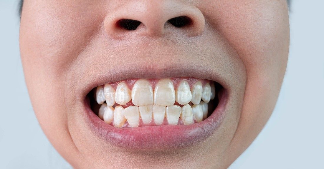 White Spots on Teeth - Causes & Treatments | makeO Blog